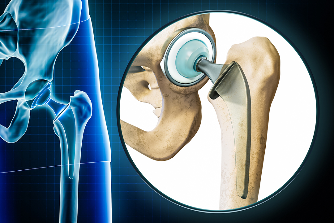 Hip Replacement Restores Mobility, Relieves Pain - Your Ortho Solution